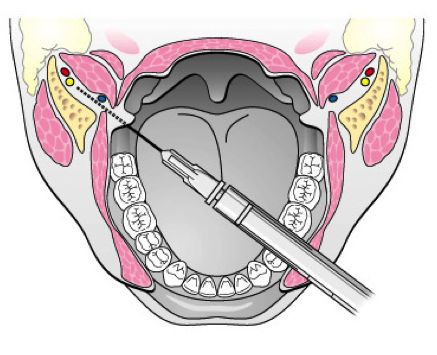 Dental block infusion – CTIA